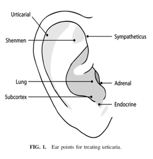 אורטיקריה - כל מה שרציתם לדעת ולא העזתם לשאול | MedPortal